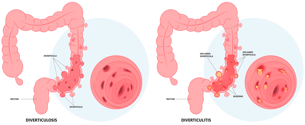 Colidur Nedir ve Ne İçin Kullanılır? - Önce Vatan Gazetesi